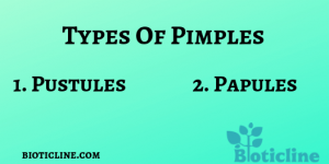 Home Remedies For Pimples And Acne